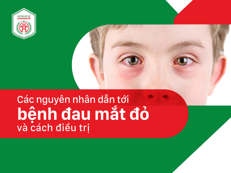 TUYÊN TRUYỀN PHÒNG CHỐNG BỆNH ĐAU MẮT ĐỎ - Hệ thống Liên cấp Lômônôxốp